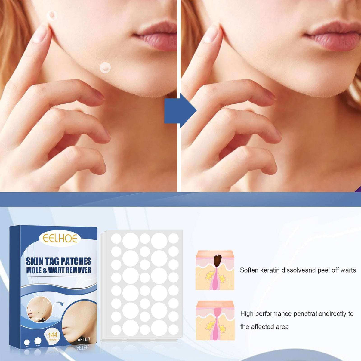 Skin Tag Removal Patches - Fast & Effective – Soloist